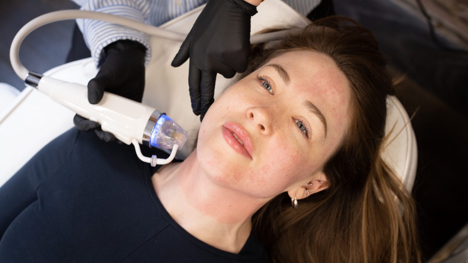 Everything you need to know about Radiofrequency Microneedling — Tweak East